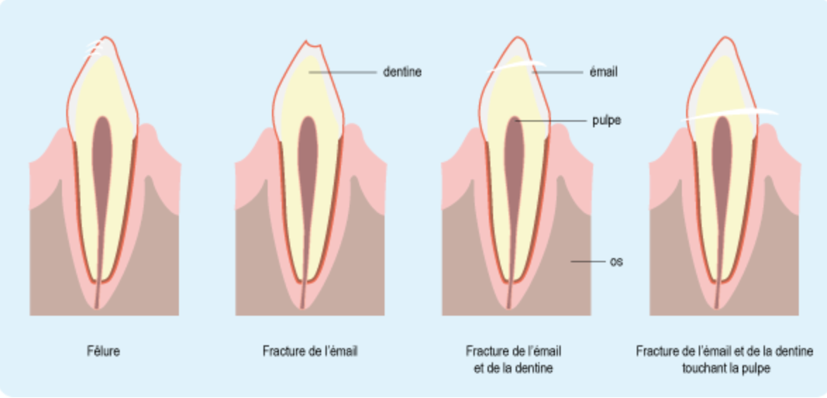Traumatisme dentaire – Merckx Pédiatrie